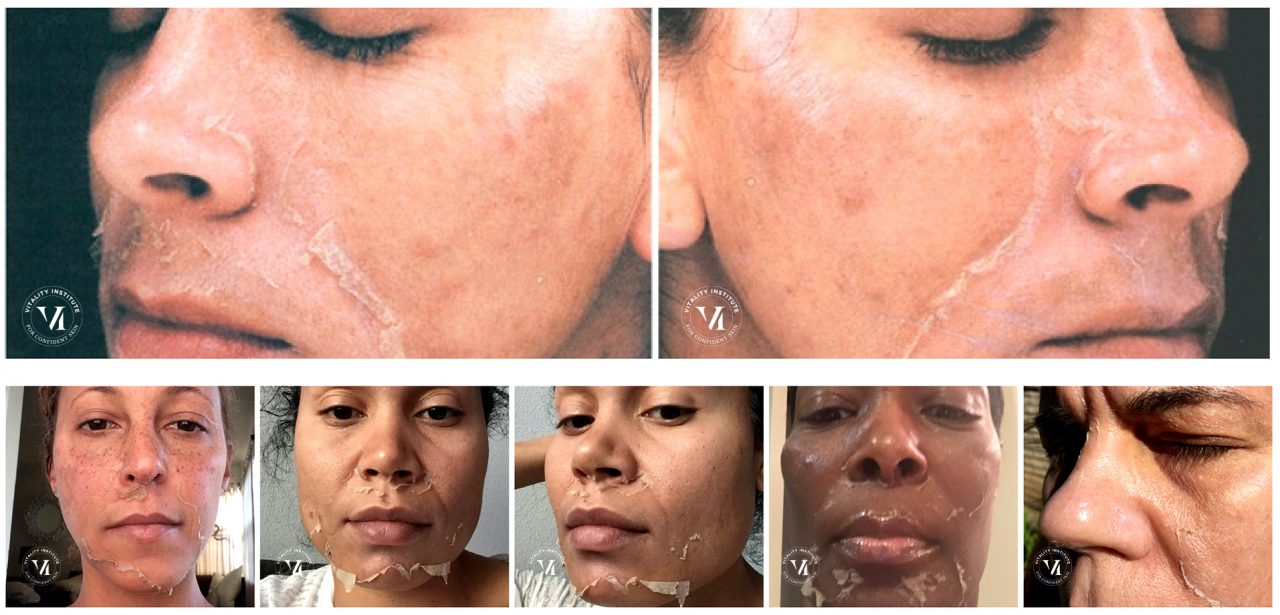 VI Peel | Reveal Clearer, Younger Skin | MD Esthetics