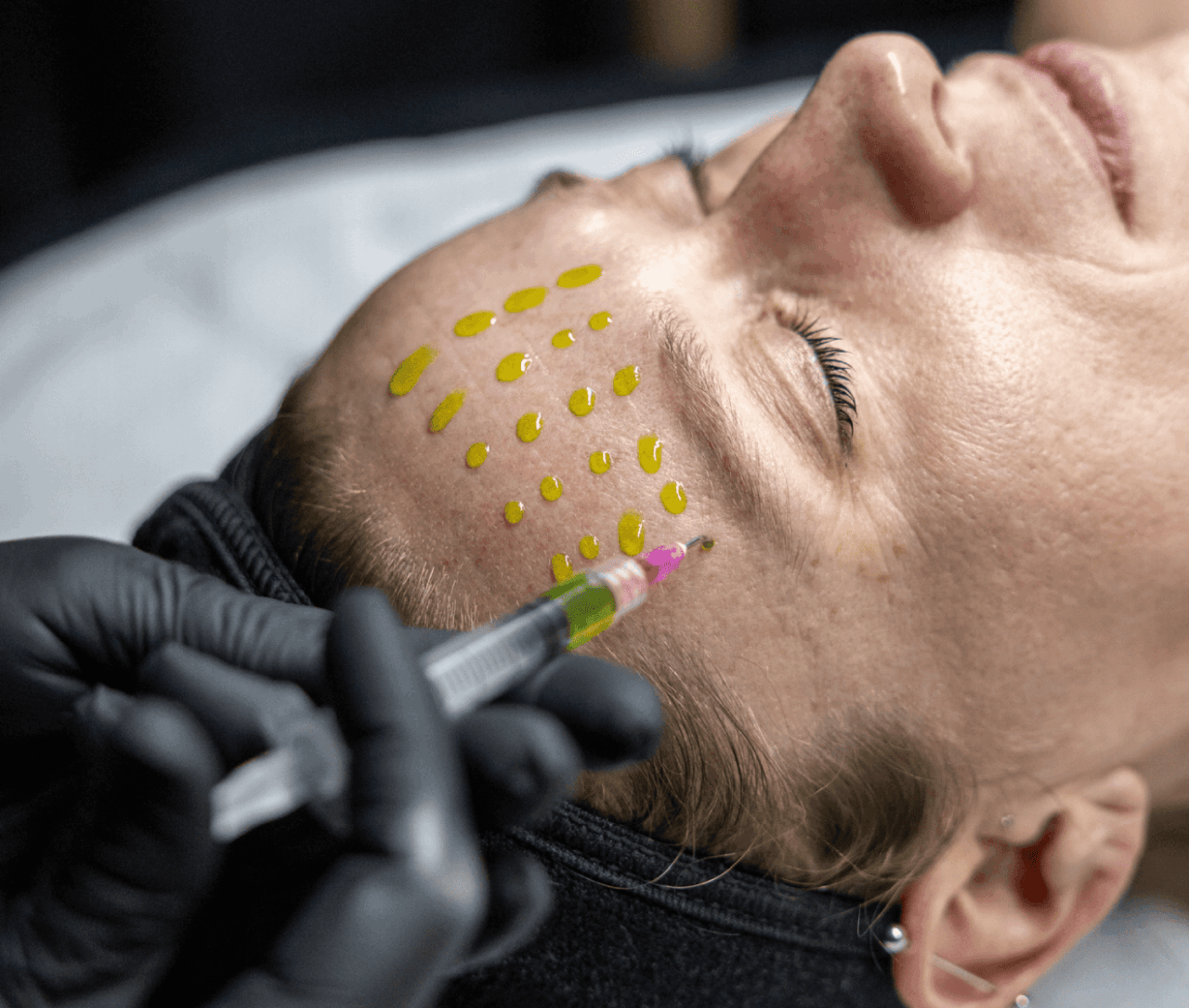 Professional Chemical Peel Treatments | MD Esthetics